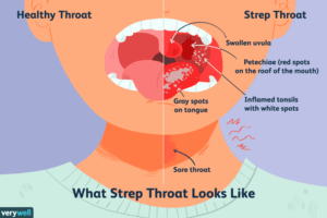 Feeling of Something Stuck in Throat Causes & Solutions | HealthyTipp